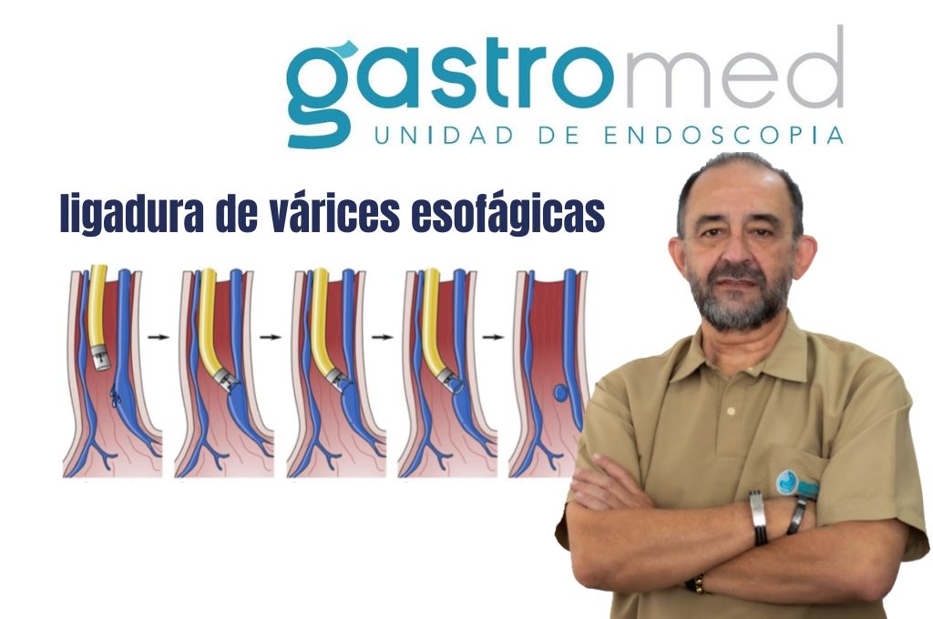 Ligadura de varices esofágicas - GASTROMED - Cúcuta